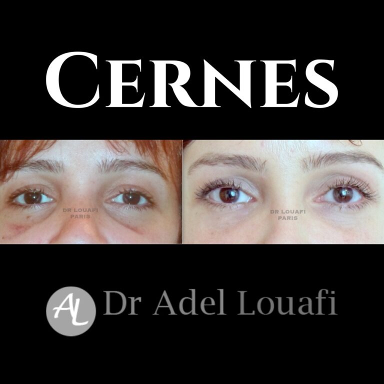 Traitement des cernes : injections d'acide hyaluronique | Paris | Dr Louafi