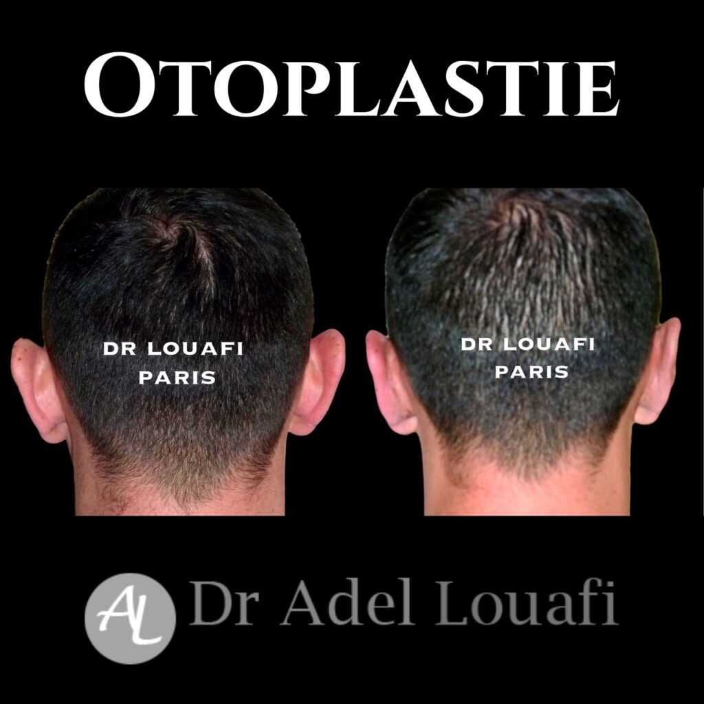 Otoplastie : chirurgie de l'oreille | Technique et tarifs | Paris | Dr ...